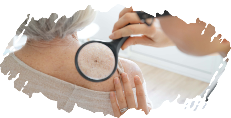 Types of Skin Lesions | East Maitland Skin Cancer Clinic